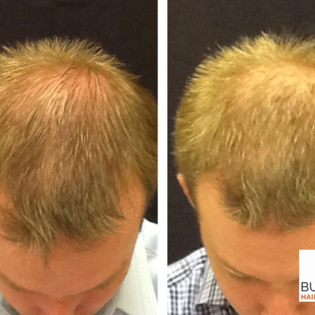 Before And After Fue Hair Restoration Platelet Rich Plasma Therapy