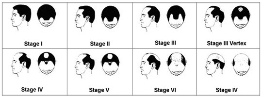Norwood_Hamilton_chart - Buckhead Hair Restoration