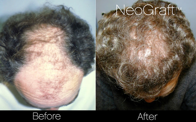 Atlanta Male Hair Restoration Neograft Buckhead Hair Restoration
