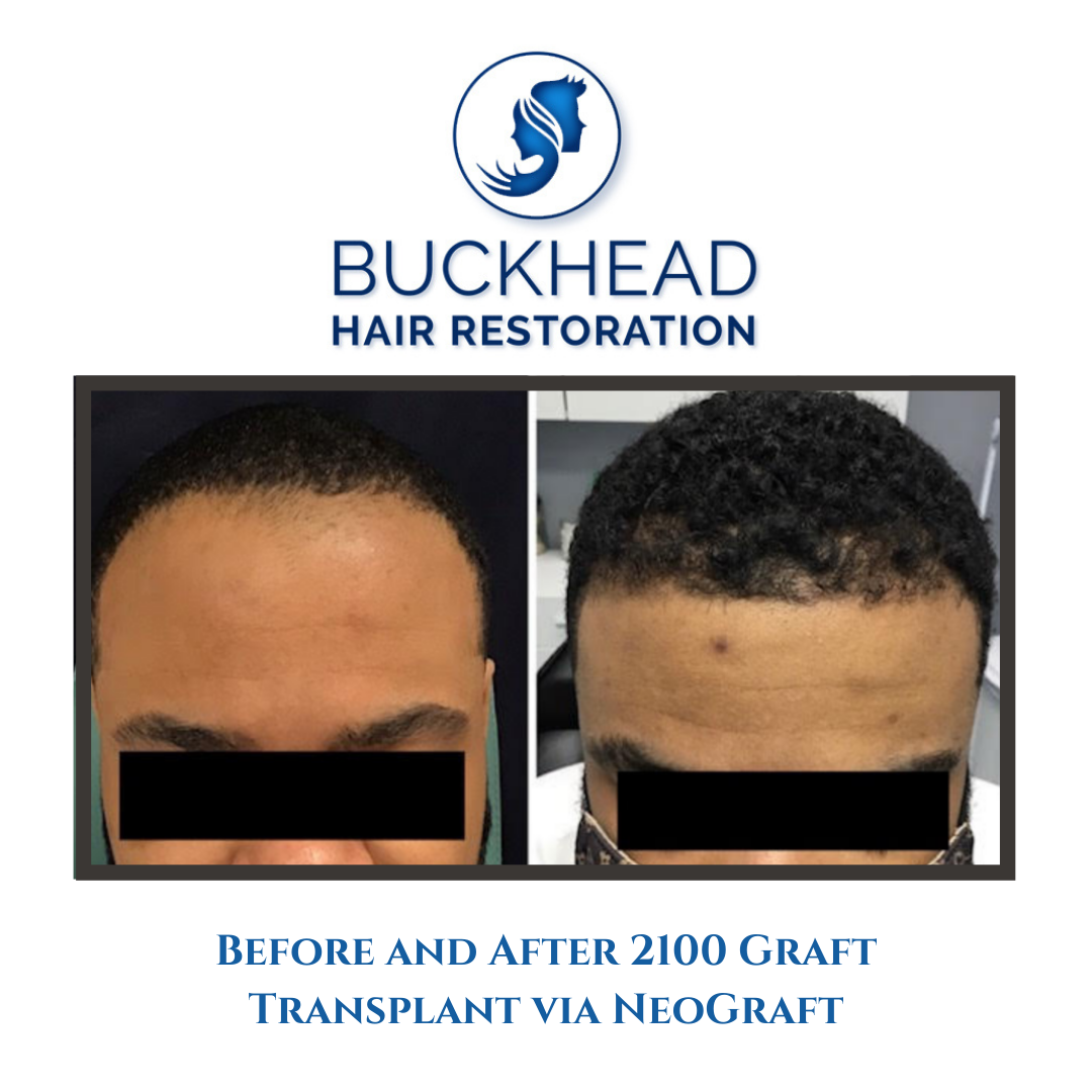 Atlanta’s #1 Hair Restoration Clinic | Buckhead Neograft Provider Atlanta’s #1 Hair Restoration Clinic | Buckhead Neograft Provider