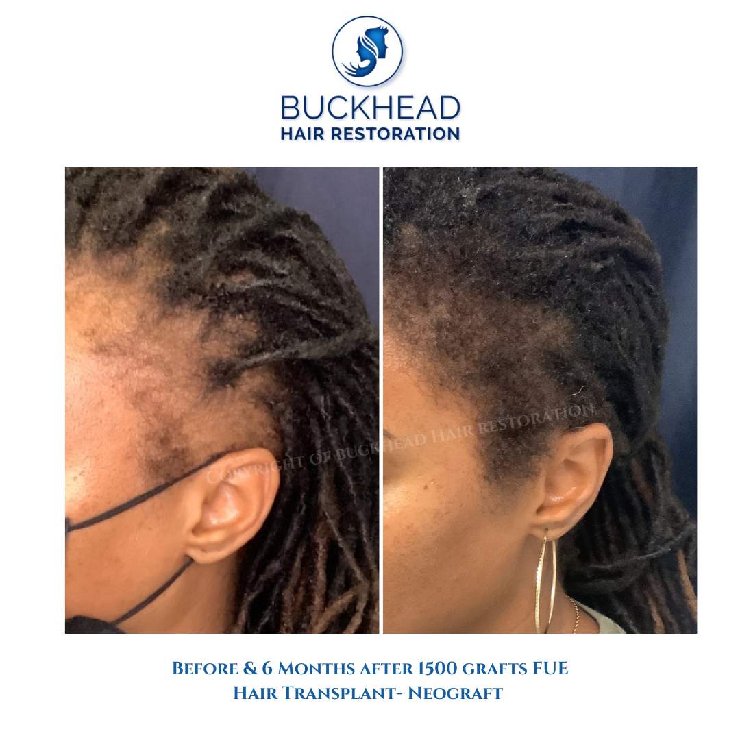 Buckhead Hair Restoration 1 Neograft Clinic