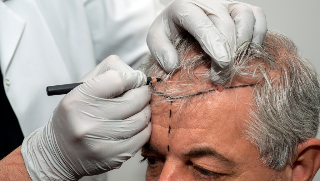 Top Hair Restoration Treatments That Actually Work in 2025
