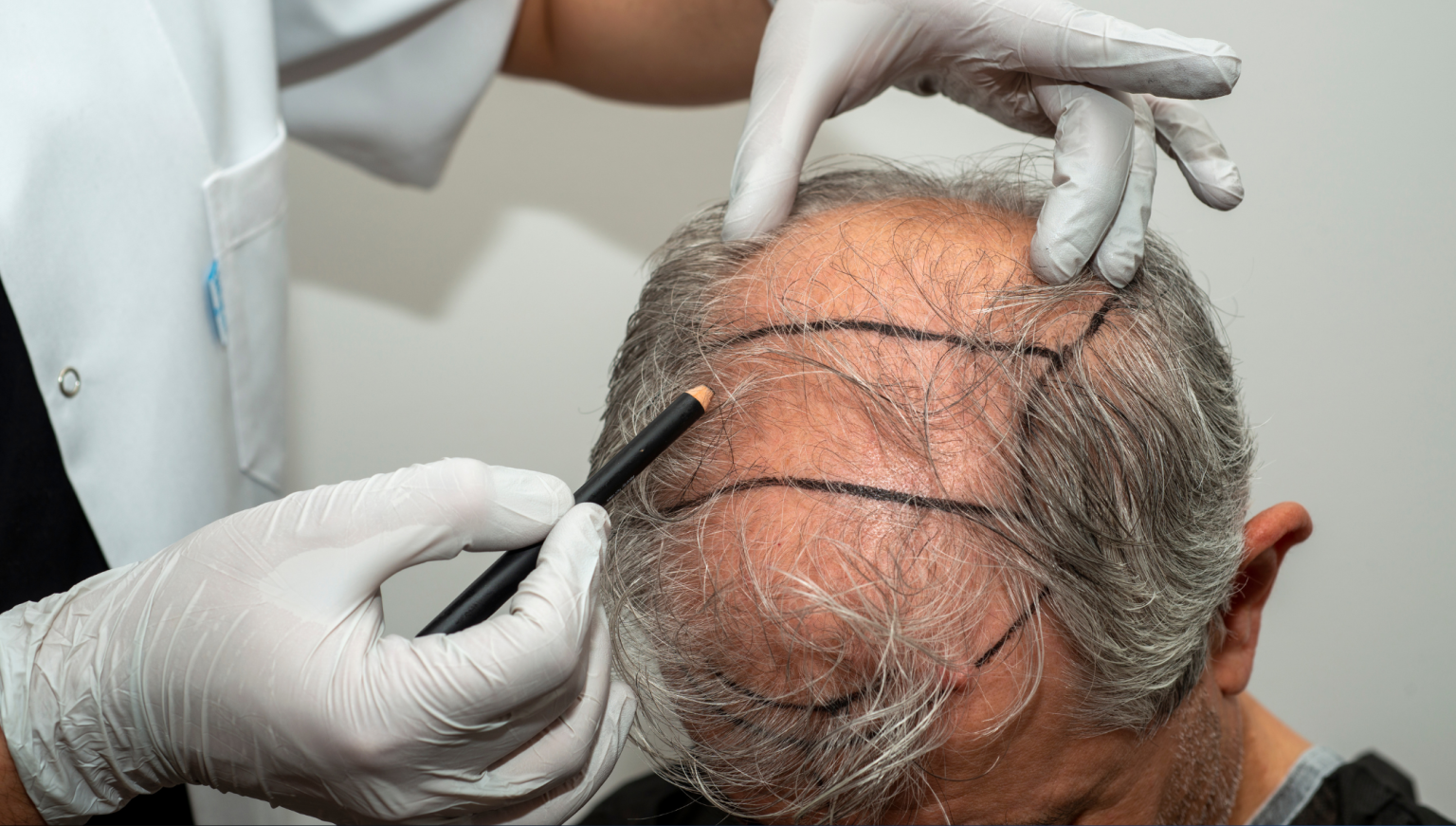What to Expect During Your First Hair Restoration Consultation
